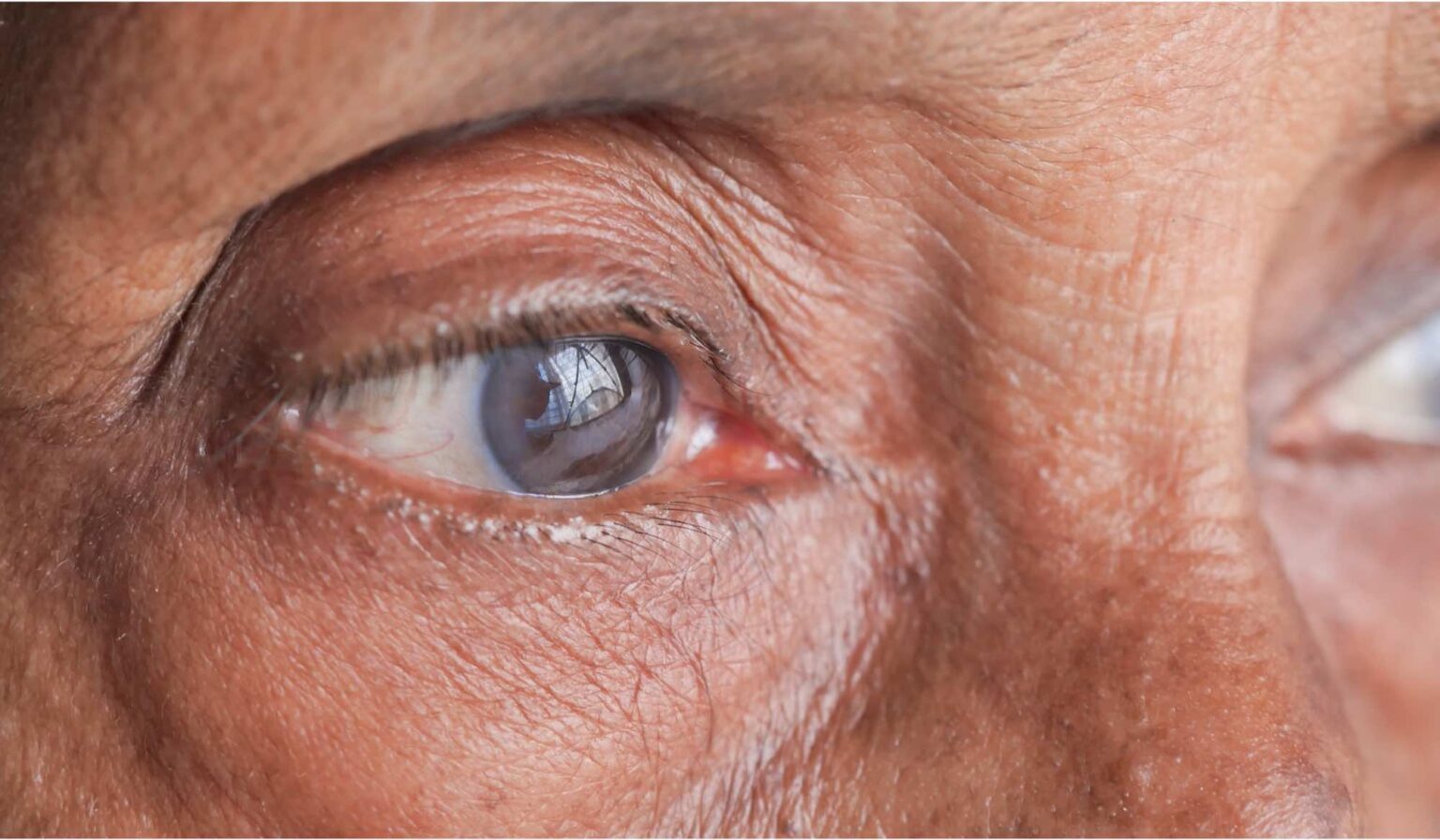 RCS Auge Spritze: Moderne Therapieansätze bei Retinopathia centralis ...